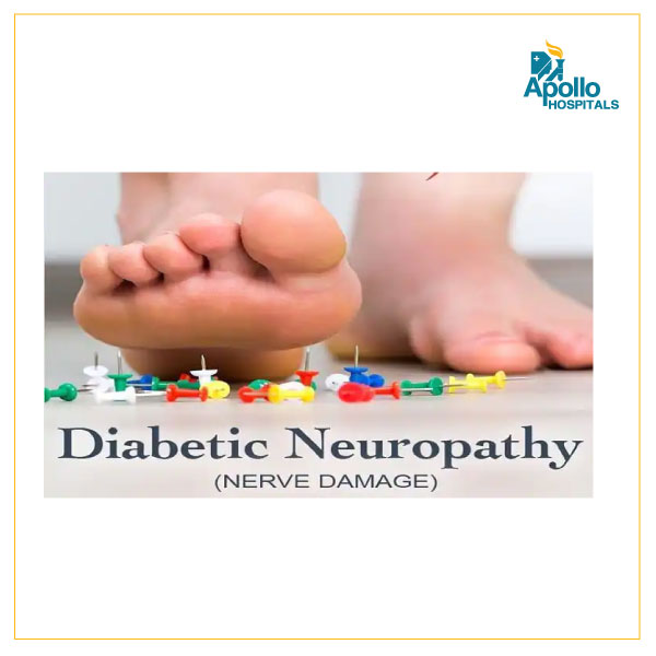 Diabetic Neuropathy – Causes, Symptoms, Diagnosis and Treatment ...