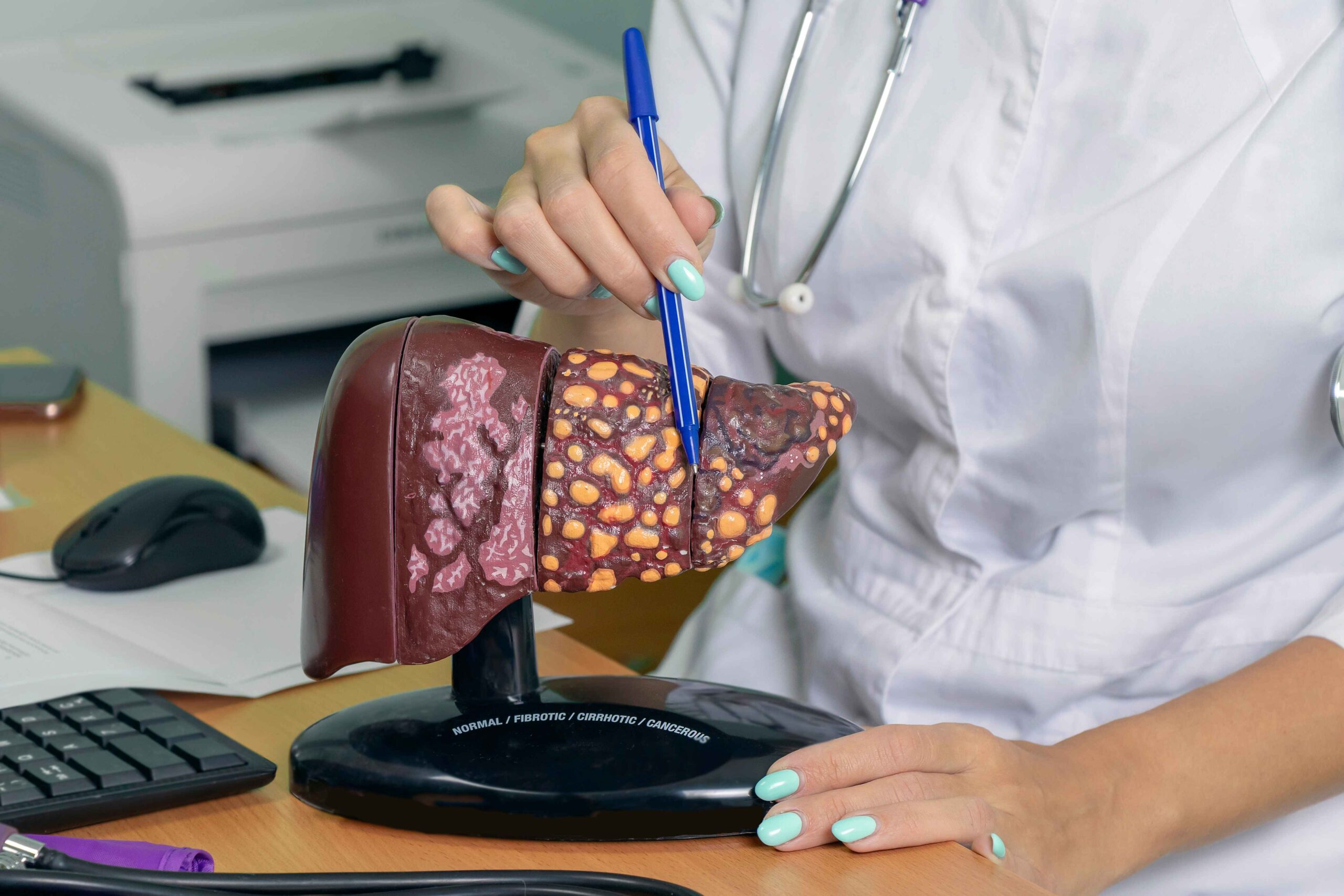 Leverkanker overlevingskansen en prognose - Apollo Proton