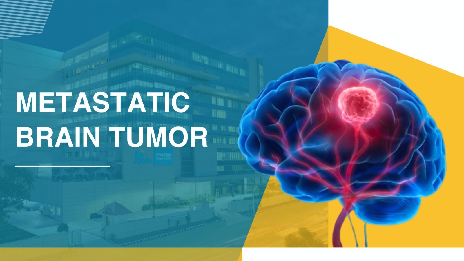 Metastatic Brain Tumours: Treatment Insights & Management - Apollo Proton
