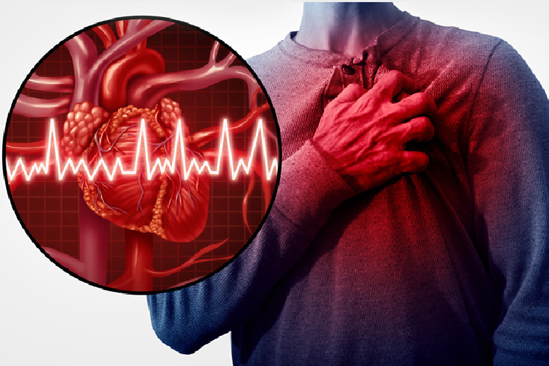 What Is Heart Attack or Myocardial Infarction (MI) | Heart Attack ...
