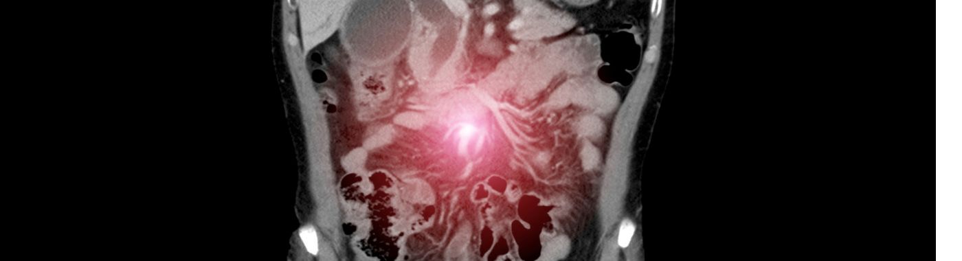 Impeksyon sa Balat ng Fungal - Mga Sanhi, Sintomas, Diagnosis at Paggamot