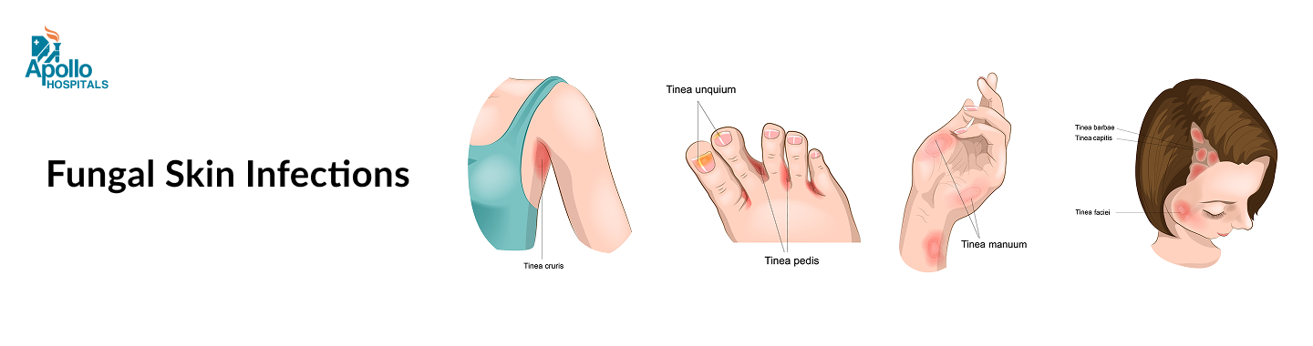 Purpura - Causes, diagnostic et traitement