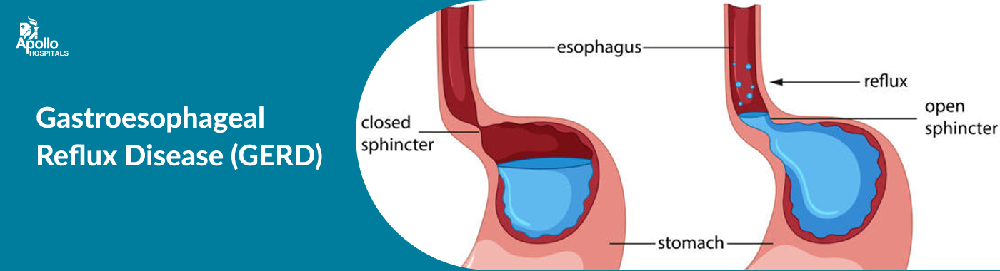 Mandelsteiner - årsaker, symptomer, diagnose og behandling
