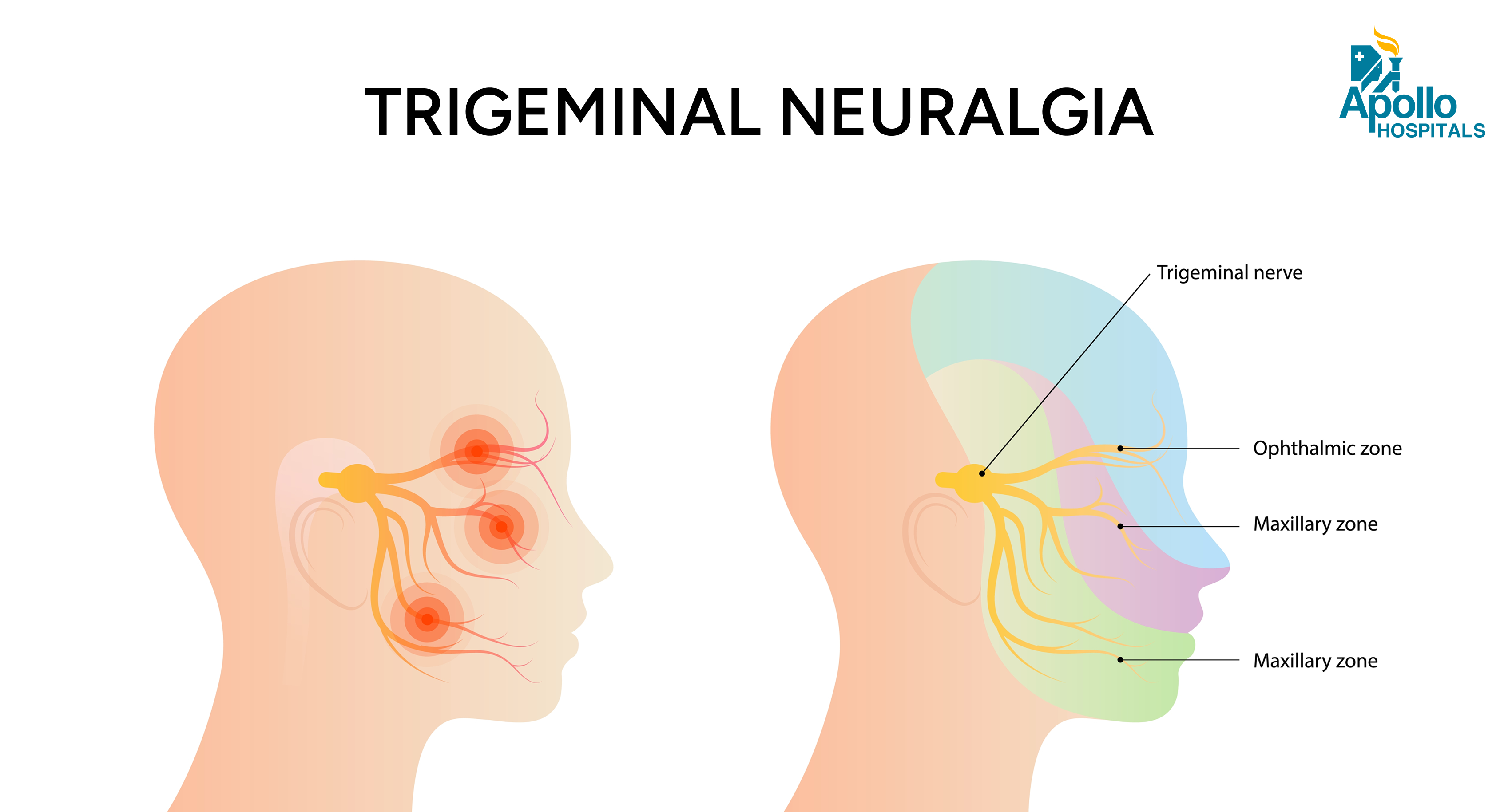 Neuralgia del trigémino: causas, síntomas, diagnóstico y opciones de tratamiento