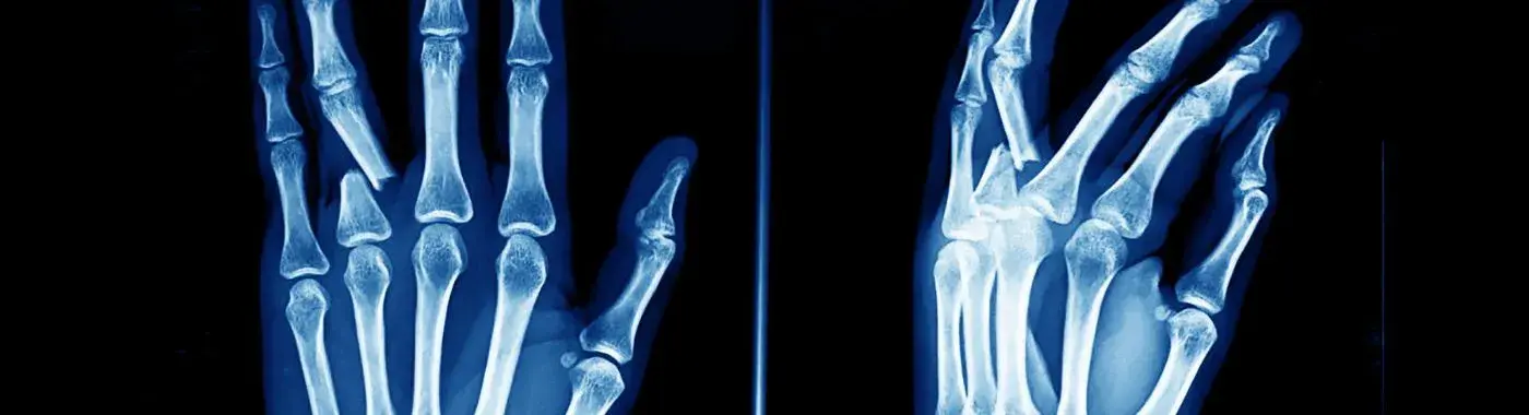 barton's fracture radiopedia