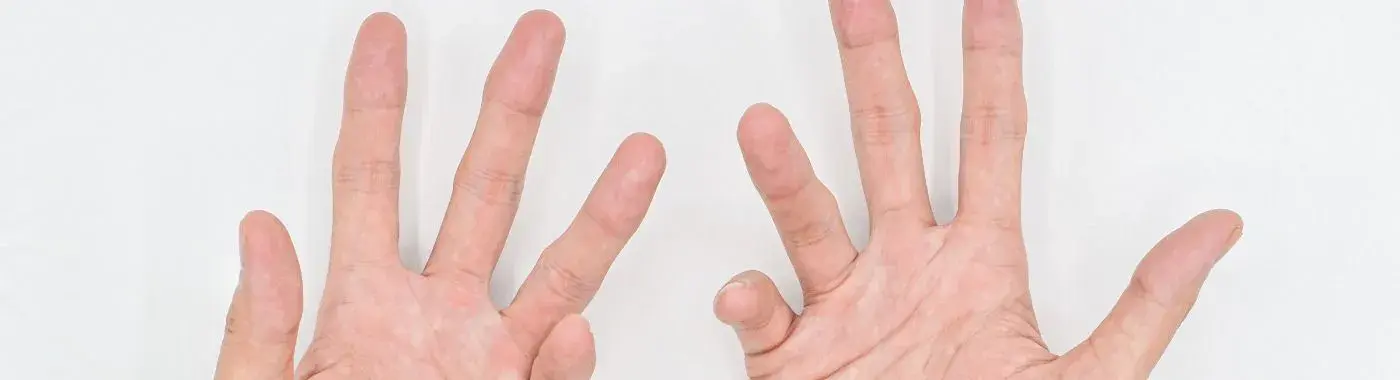 Dupuytrens Contracture - Causes, Symptoms, Diagnosis, and Treatment