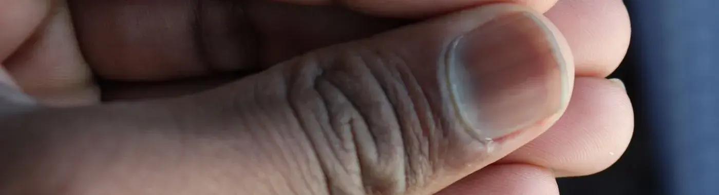 Splinter Hemorrhage - Causes, Symptoms, Diagnosis, and Treatment