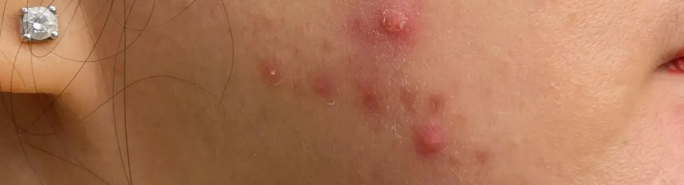 inflammatory acne