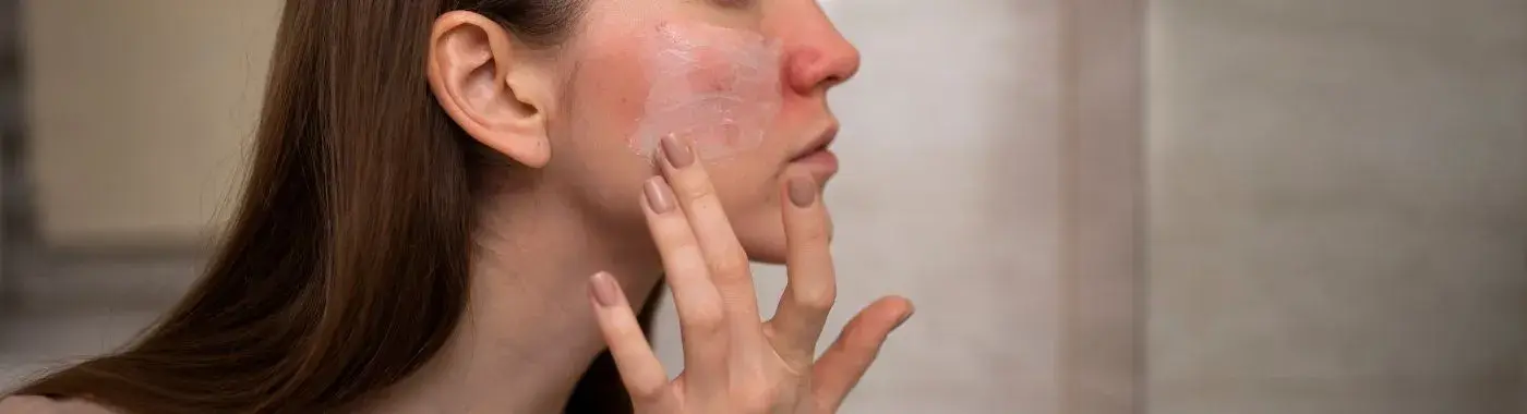 Talgklierhyperplasie - Oorzaken, symptomen, diagnose en behandeling